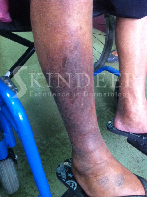 Gravitational Eczema Skindeep Barbados 5361